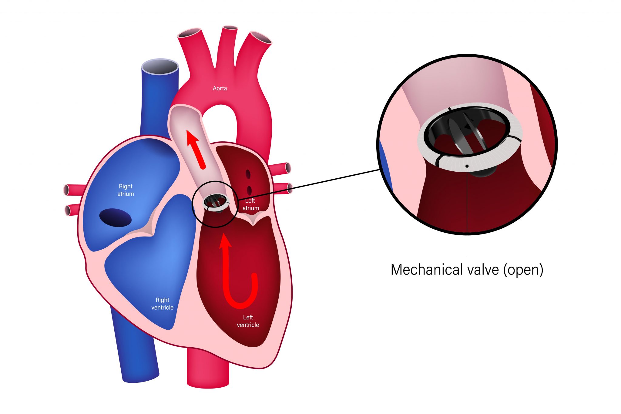 Why Heart Valve Surgery Is Needed: A Complete Guide for Patients?